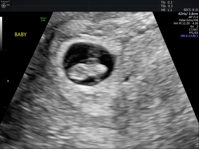 7 week ultrasound. - Glow Community