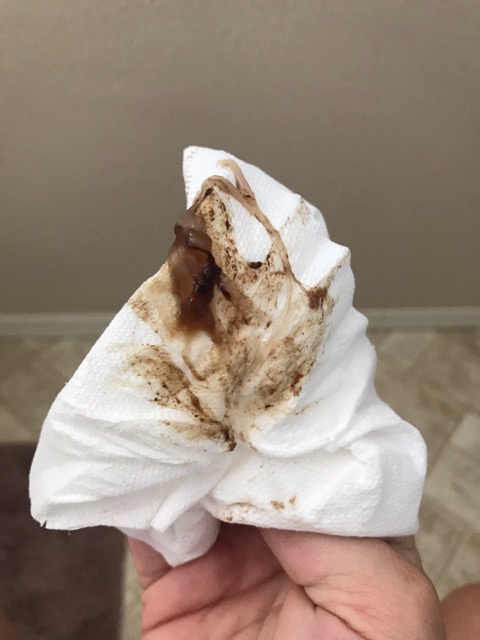 Bloody show or mucus plug? - Glow Community