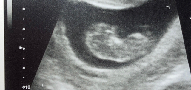 This is my 11 week scan do you think it looks normal? Not being able to ...