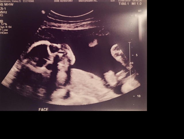 20-week-anatomy-scan-glow-community