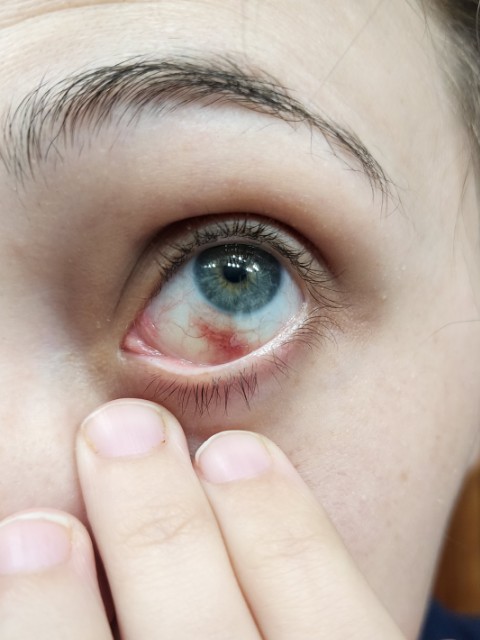 Ruptured blood vessel in eye with no idea how it happened? Cause for ...