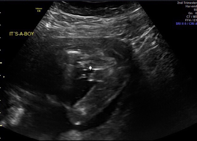 20 week Anatomy Scan - Glow Community