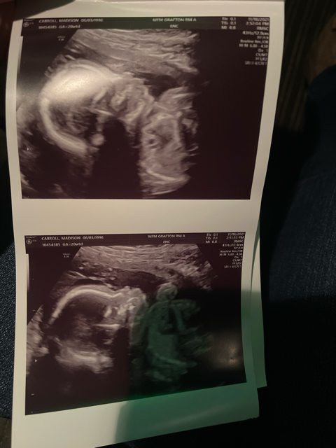 20 Week Anatomy Scan! - Glow Community