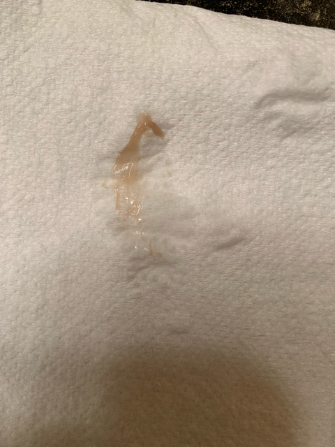 5 weeks discharge, is this normal? - Glow Community