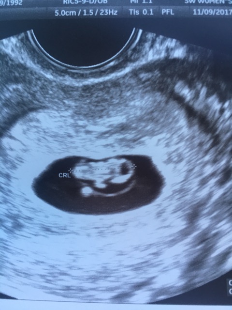 7 weeks ultrasound POST YOUR ULTRASOUND BELOW - Glow Community