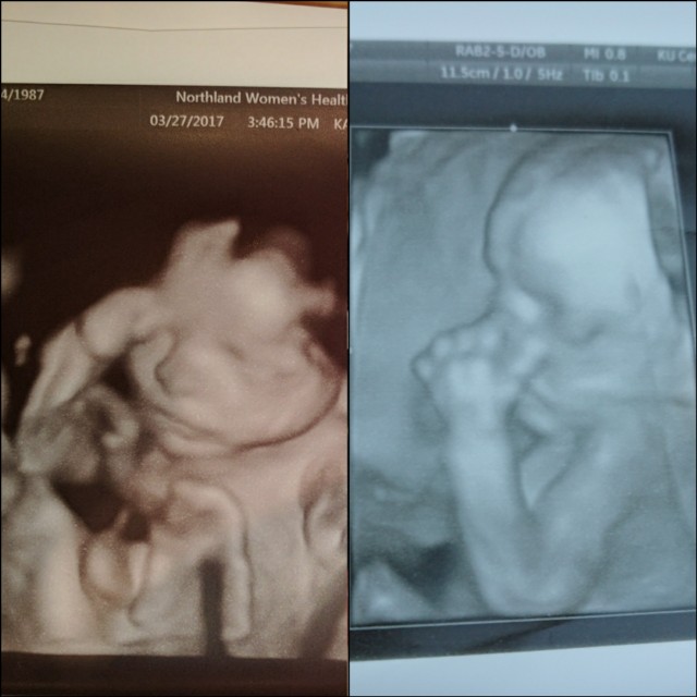 22 week anatomy scan - Glow Community