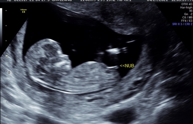 Nub theory- 12 weeks and 4 days - Glow Community