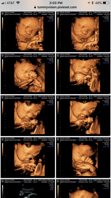 3D Ultrasound (32 weeks with Ava Skye) - Glow Community