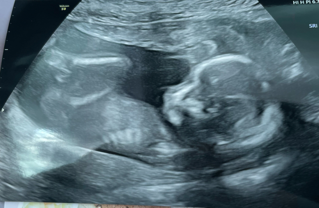 8 Weeks Postpartum Retained Placenta