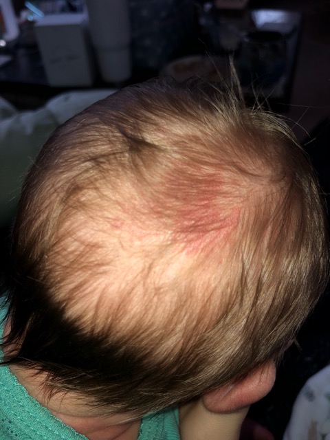 What is this rash/bruise on the back of her head? She’s 12 days old ...