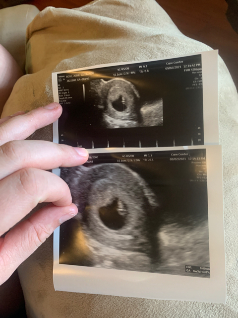 6 weeks 5 days today! This is my ultrasound from earlier this week. I ...