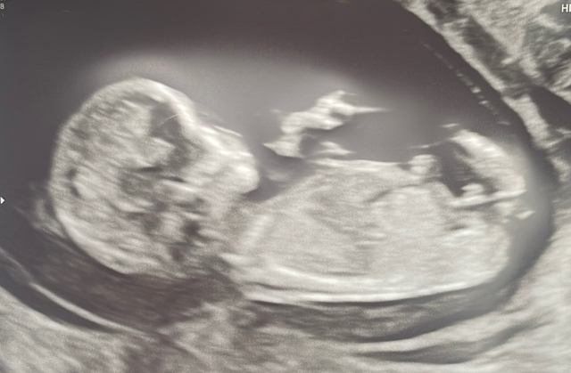 13 week scan can anyone tell boy or girl? - Glow Community