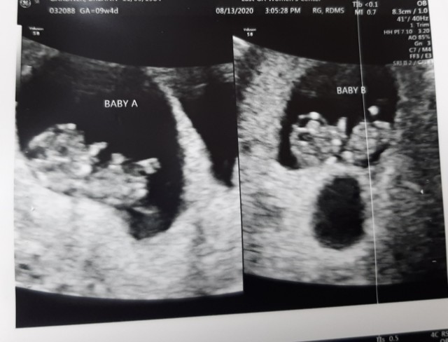 9w4d ultrasound! Both babies are doing great!! I got to see some wiggles and the heartbeats ...