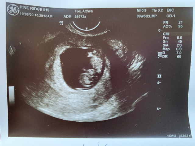 9+6. Any guesses? The placenta is on the upper left side.. theres an ...