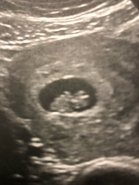 9w 2d finally had my first ultrasound. I was soooo relieved to see that ...