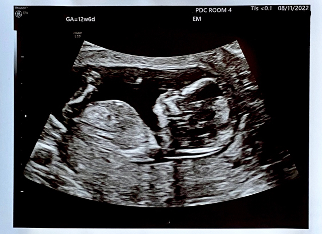 Our Double Rainbow Baby at 12w6d. Just taken this morning at the NT ...
