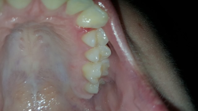 I was eating a tortilla chip and cut my gum. Now it's between my two ...