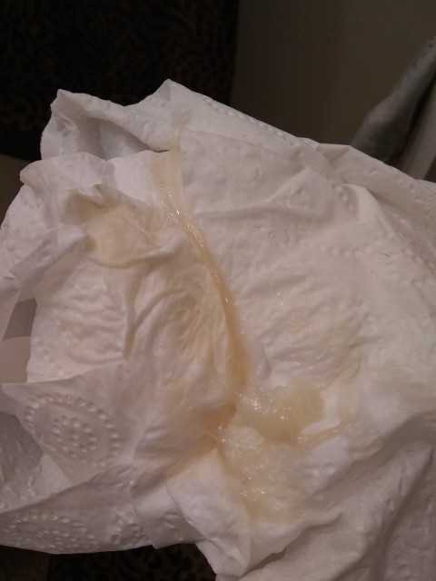 Blood Tinged Mucus Plug