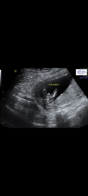14 week gender scan; photo clearly says boy but I have seen so many ...