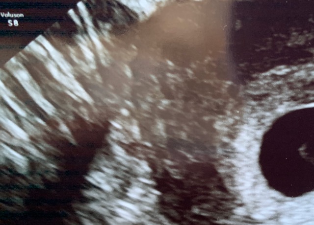 6w0d IVF pregnancy - saw yolk sac, fetal pole and heartbeat 💗 - Glow Community