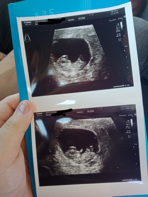 After a threatened miscarriage and rushed for an ultrasound I'm very please to say my belly bean ...