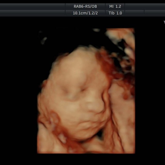 30 week 3D ultrasound..... our baby boy is just handsome already 💙💙💙 ...