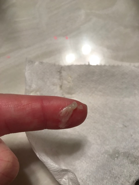 I’m 36+3- does this look like a piece of my mucus plug or just stringy ...