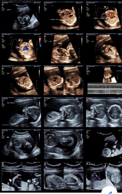 18 week anomaly scan. Anyone can confirm the gender? - Glow Community