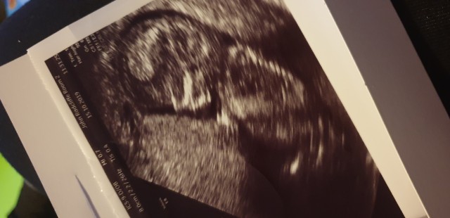 Any gender guesses? This scan was at 13 weeks. Got our gender scan ...