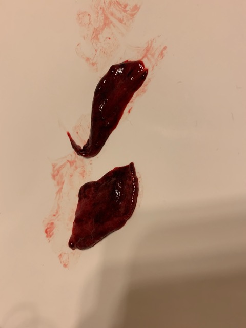 Miscarriage or big blood clot ? I started spotting after my period was ...