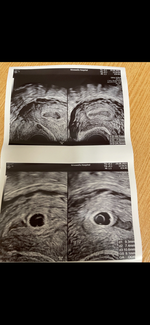 Has anyone had a scan like this before and a week later saw changes ...