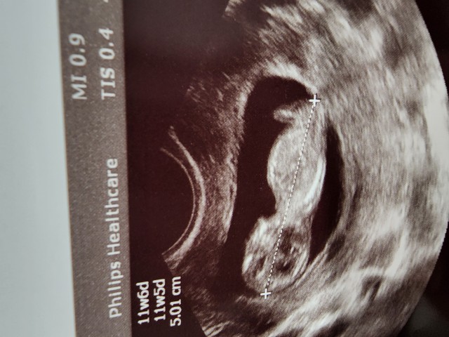 11 weeks 5 days... girl or boy? this is our rainbow baby. 🌈 - Glow ...