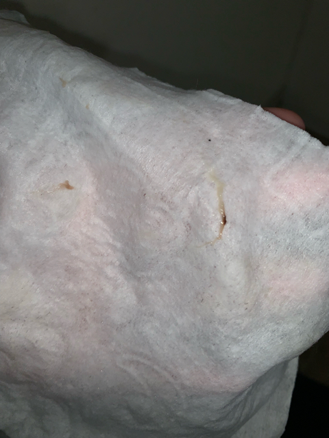 IMPLANTATION BLEEDING? At 8DPO - Glow Community